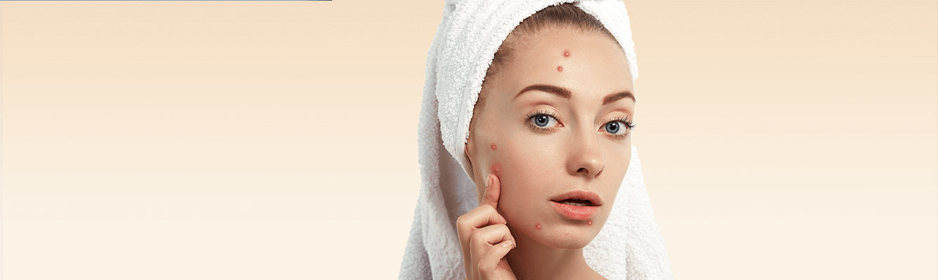 Sivilce Nasıl Geçer, Sivilceye Ne İyi Gelir? | Kotex